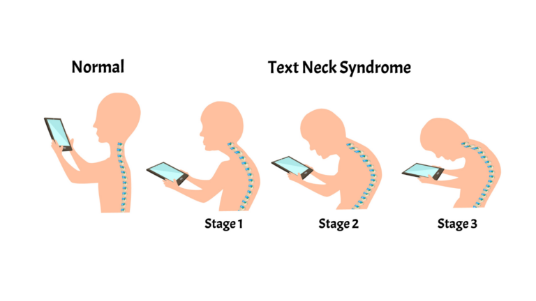 Hyperkyphosis: Yoga for a Hunched Back - YogaUOnline